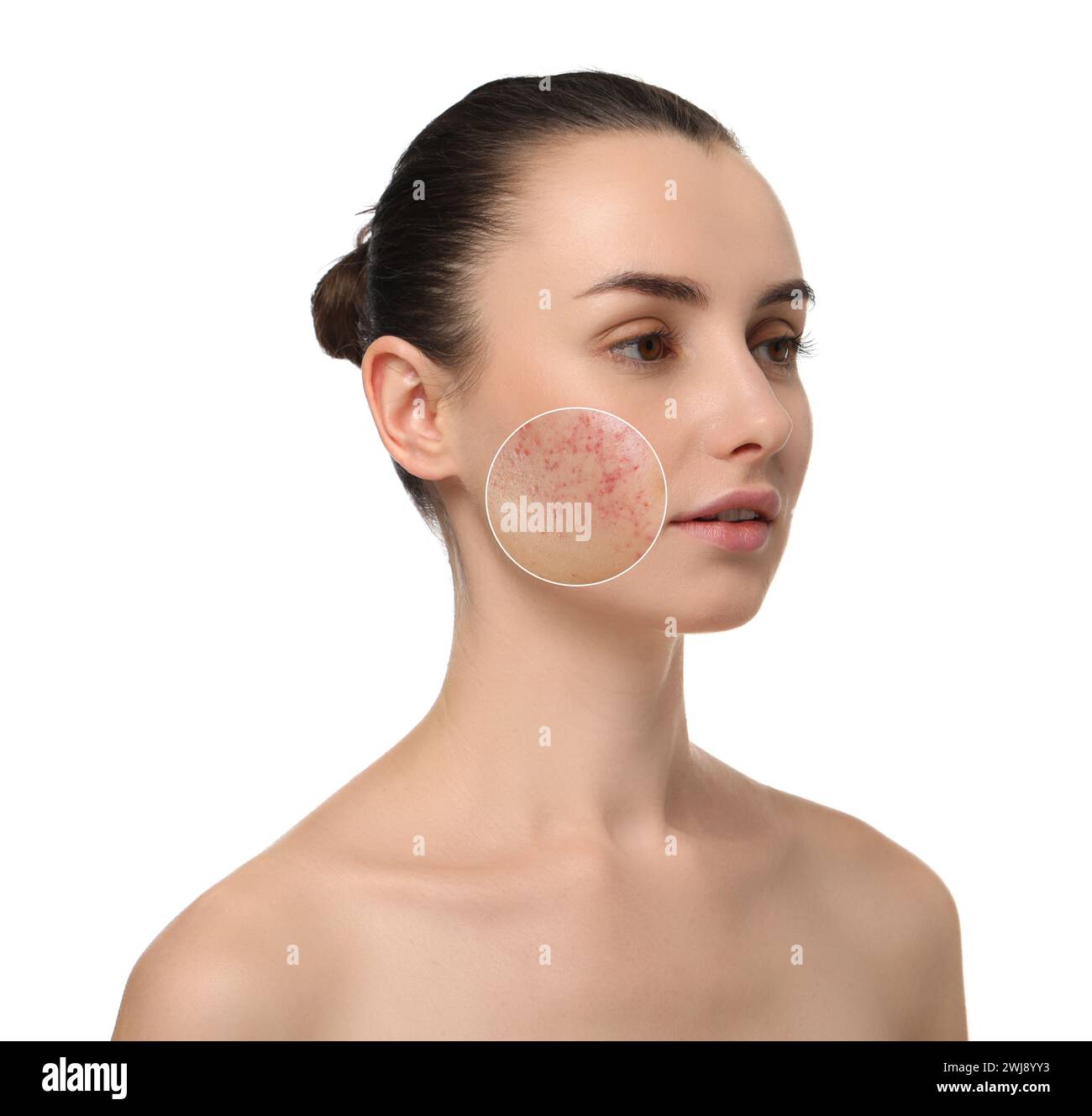 Woman before and after cosmetology procedure on white background ...