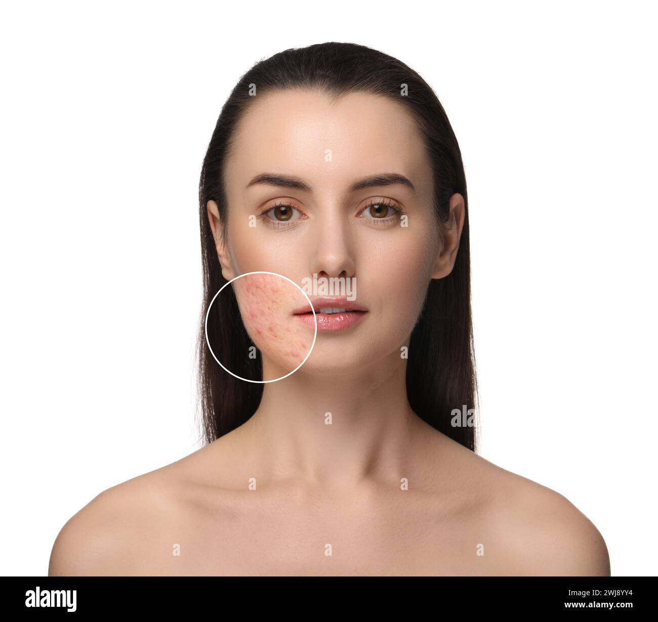 Woman before and after cosmetology procedure on white background ...