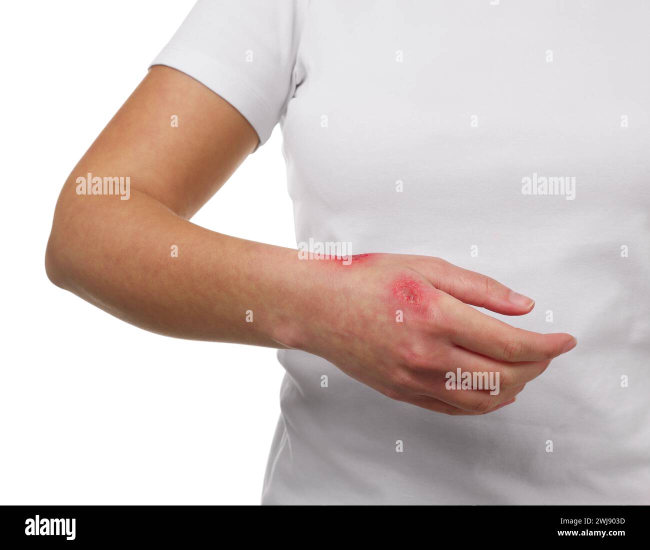 Burn mark on hand hi-res stock photography and images - Alamy