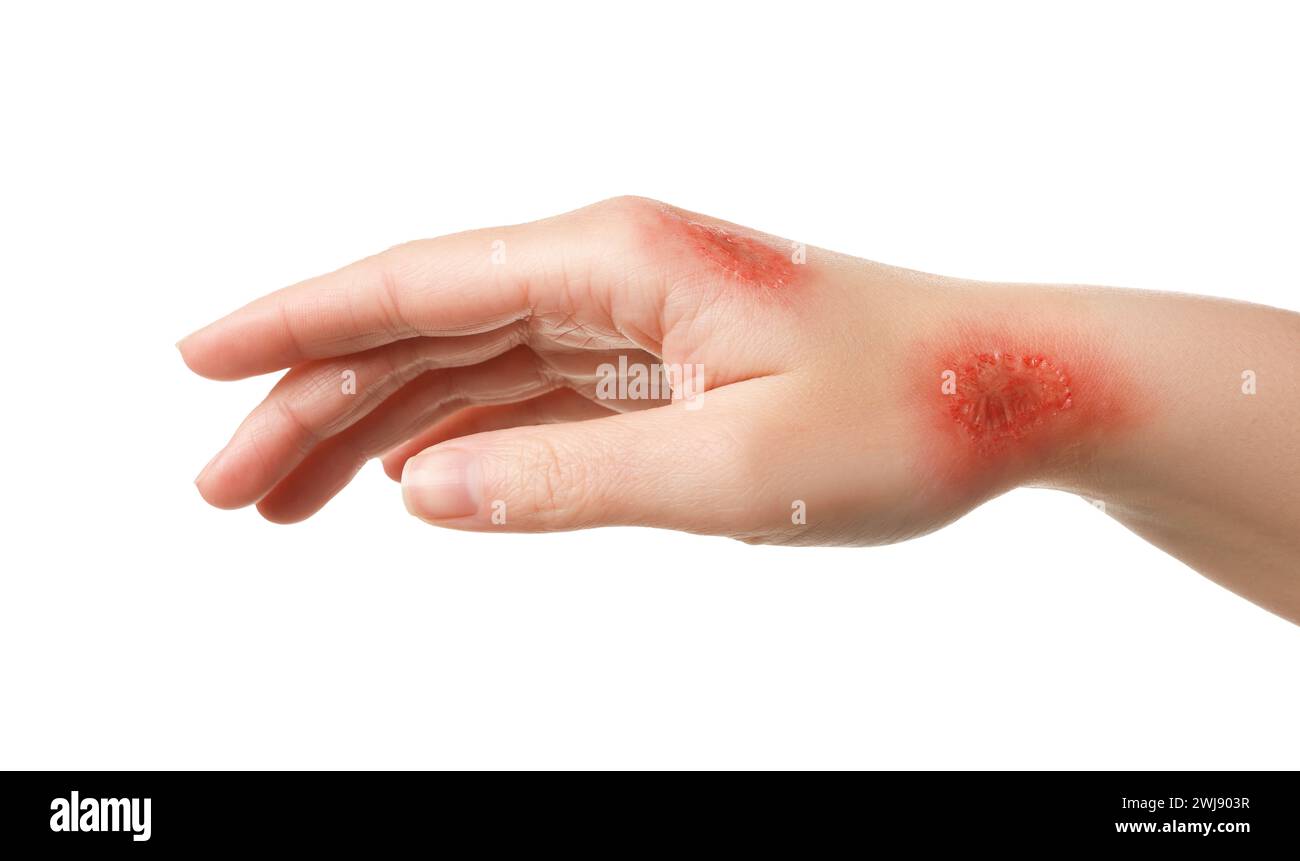Woman with burned hand on white background, closeup Stock Photo - Alamy