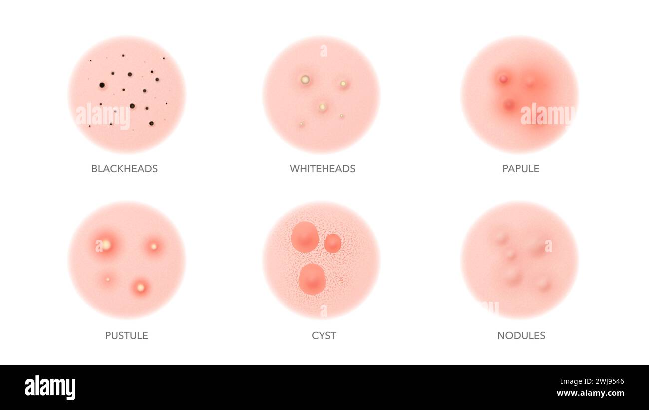 Acne Types Body Or Face Skin Pimples And Inflammation Problems Vector