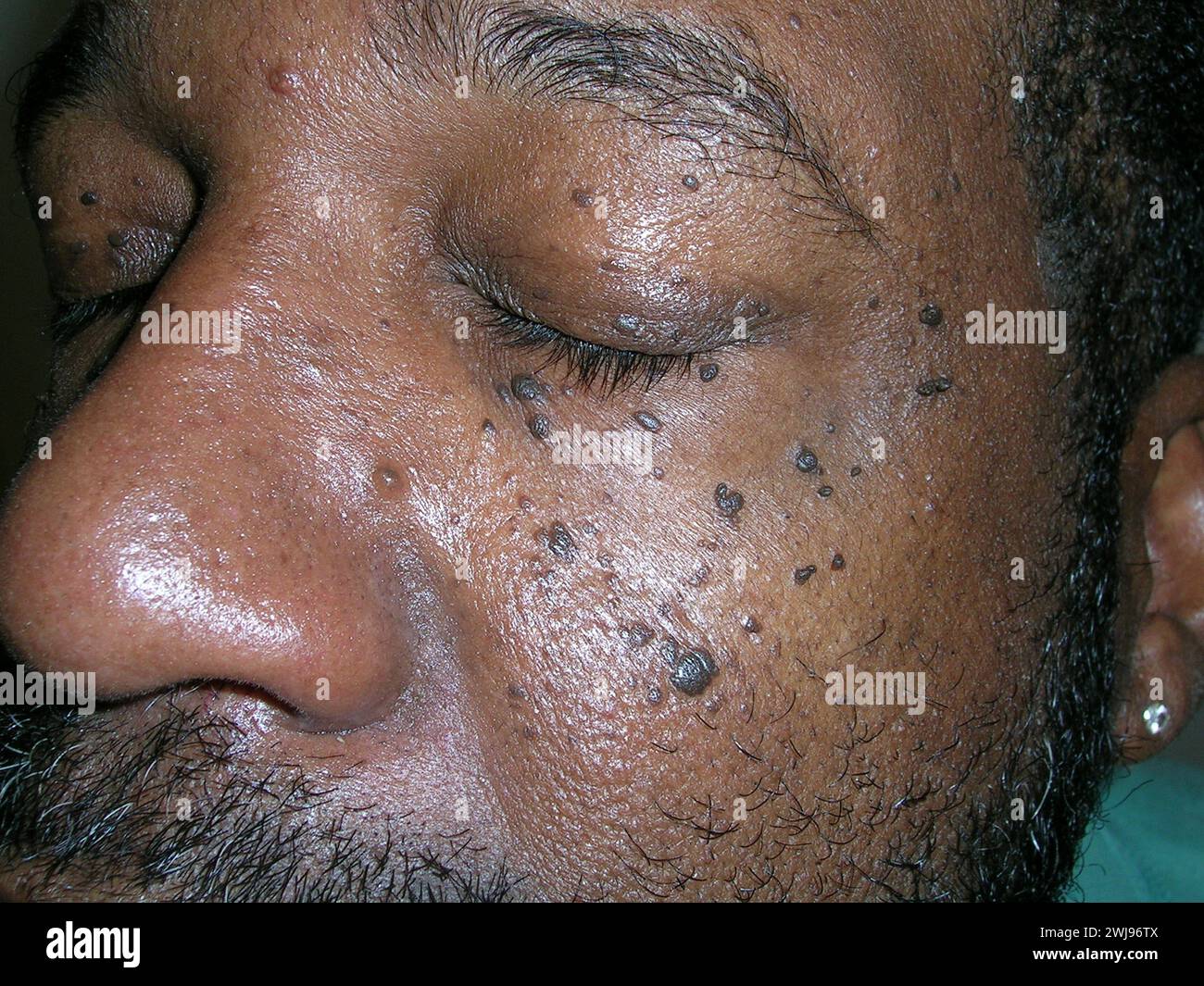 Dermatosis papulosa nigra Stock Photo - Alamy