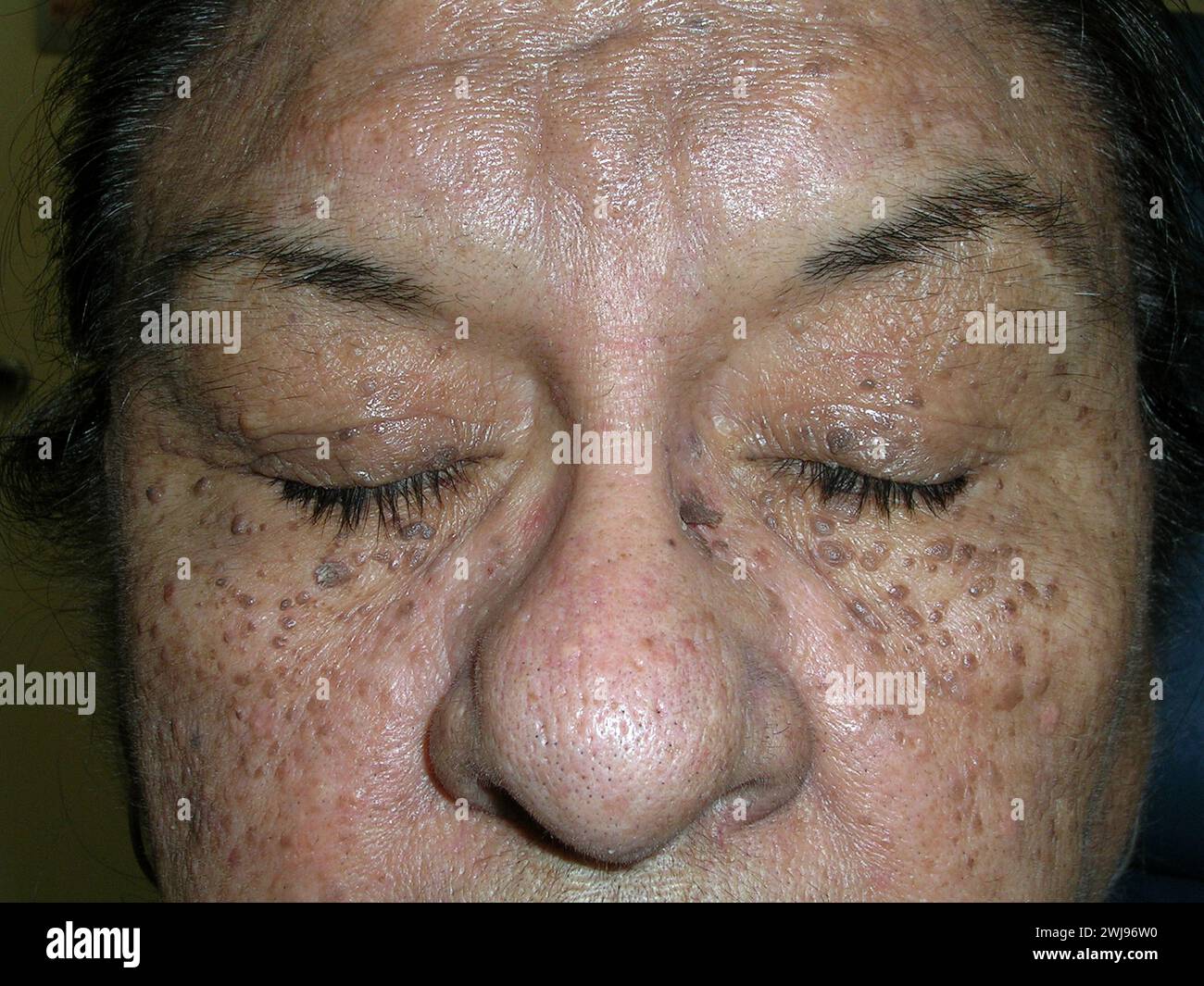 Dermatosis papulosa nigra Stock Photo - Alamy