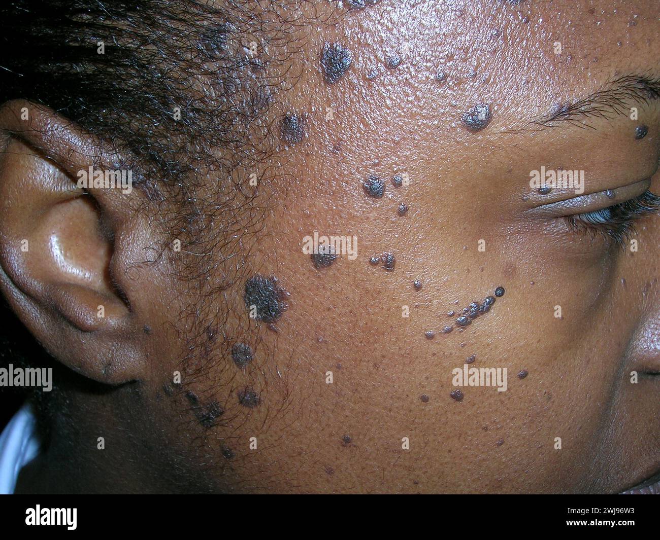 Dermatosis papulosa nigra Stock Photo - Alamy