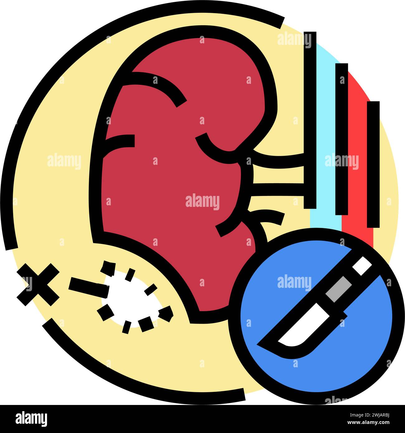 Nephrectomy hi-res stock photography and images - Alamy