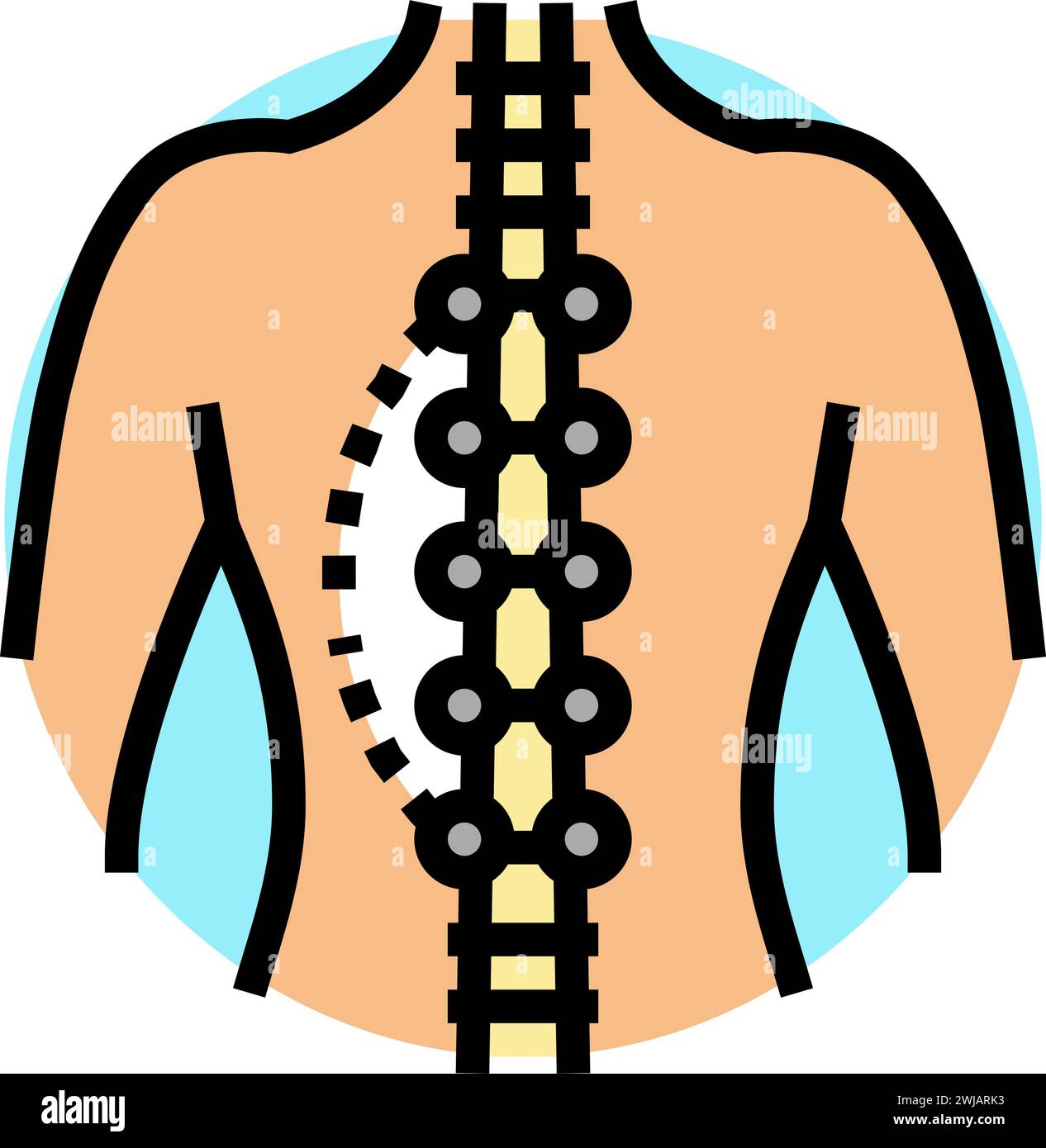 Scoliosis Surgery Surgery Hospital Color Icon Vector Illustration Stock