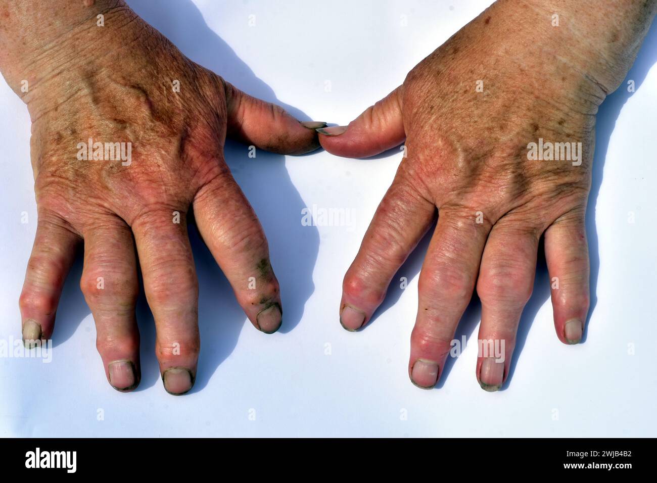 The picture shows two hands, the fingers of which have signs of ...