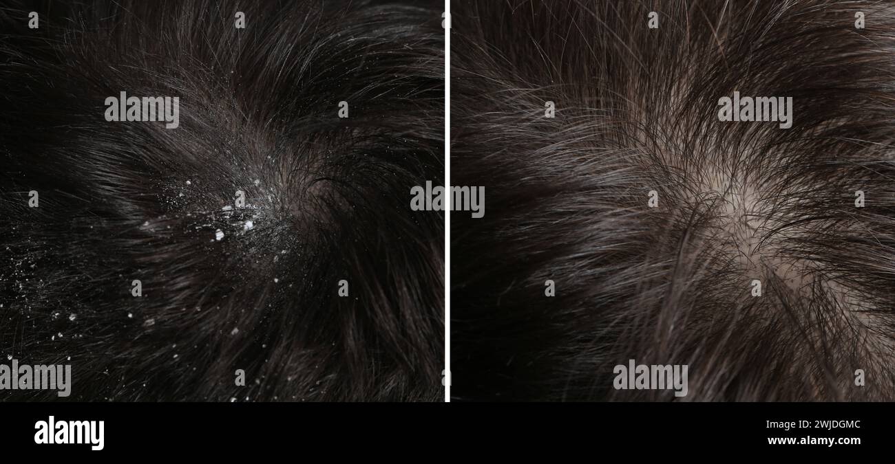 Man showing hair before and after dandruff treatment, collage Stock ...