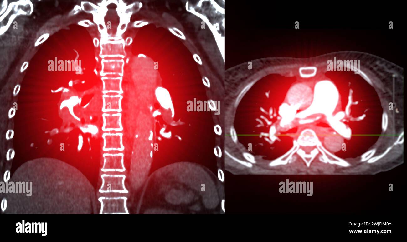 A CTA pulmonary artery reveals a detailed view of the lung blood ...