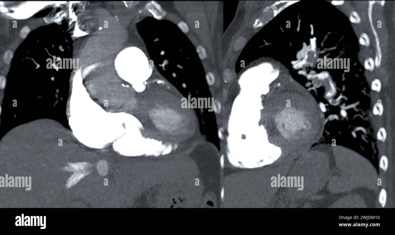 A CTA pulmonary artery reveals a detailed view of the lung blood ...