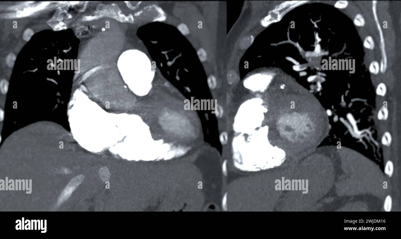 A CTA pulmonary artery reveals a detailed view of the lung blood ...