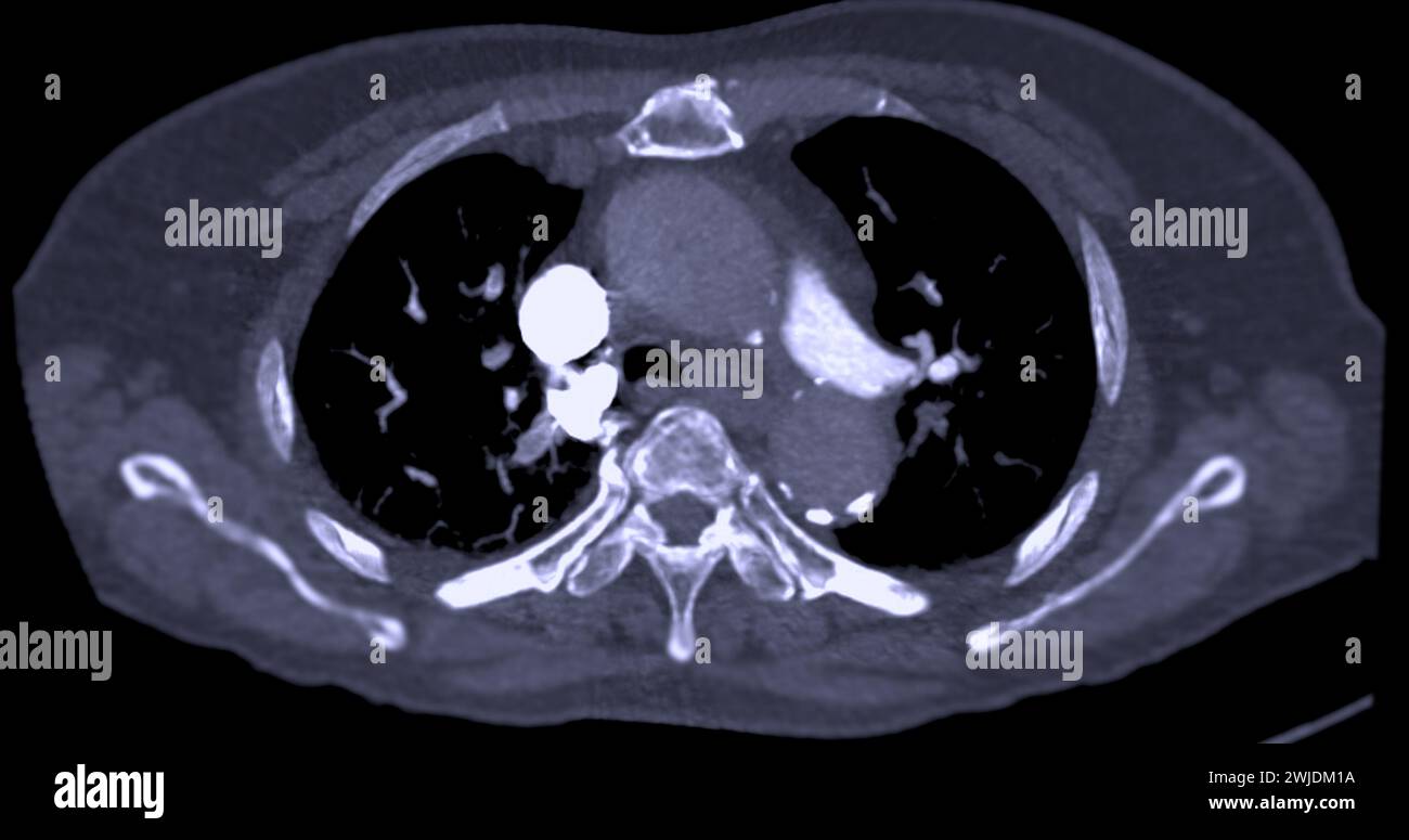 A CTA pulmonary artery reveals a detailed view of the lung blood ...