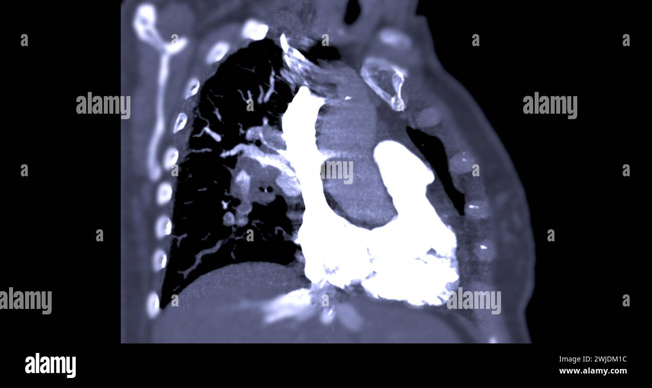 A CTA pulmonary artery reveals a detailed view of the lung blood ...