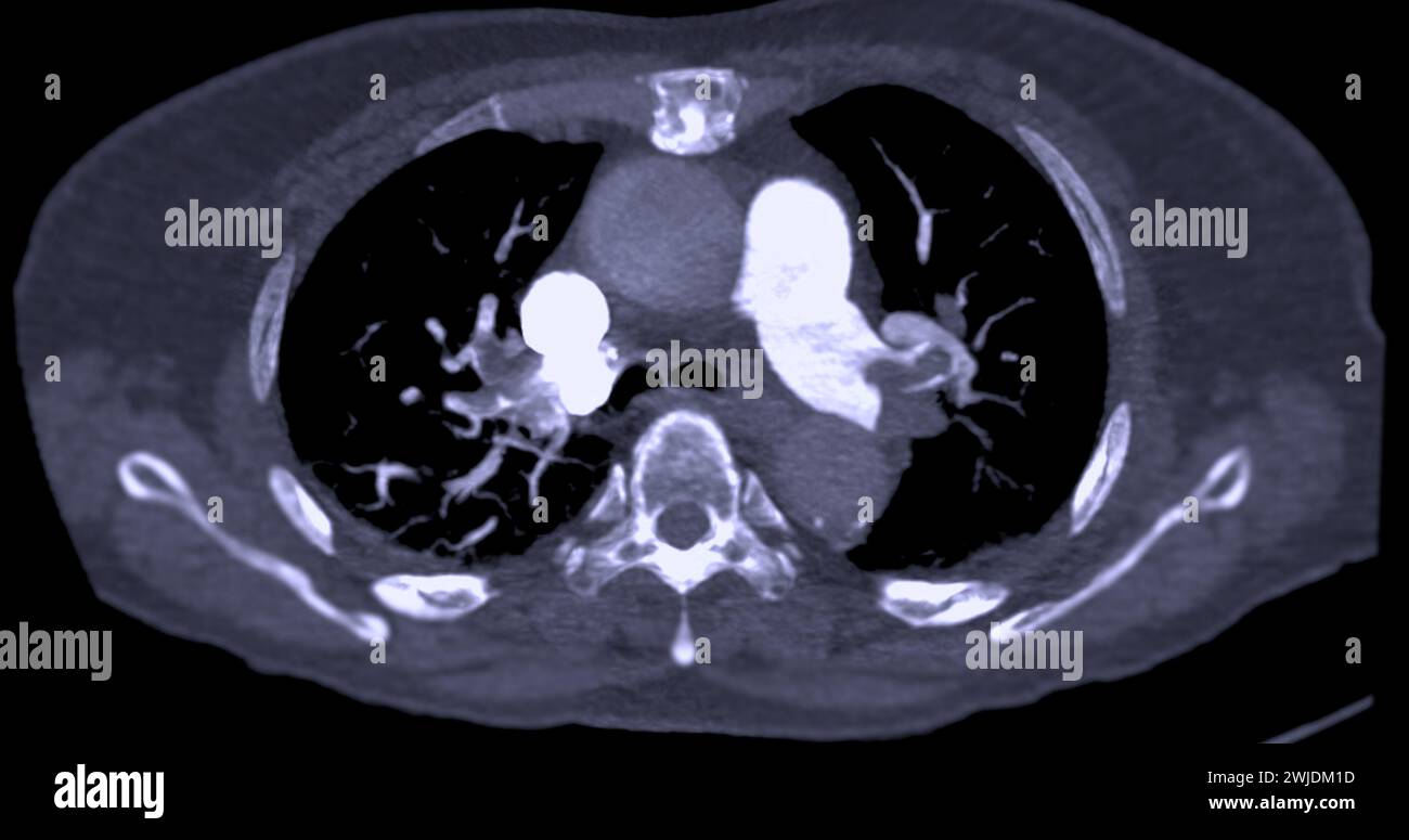 A CTA pulmonary artery reveals a detailed view of the lung blood ...