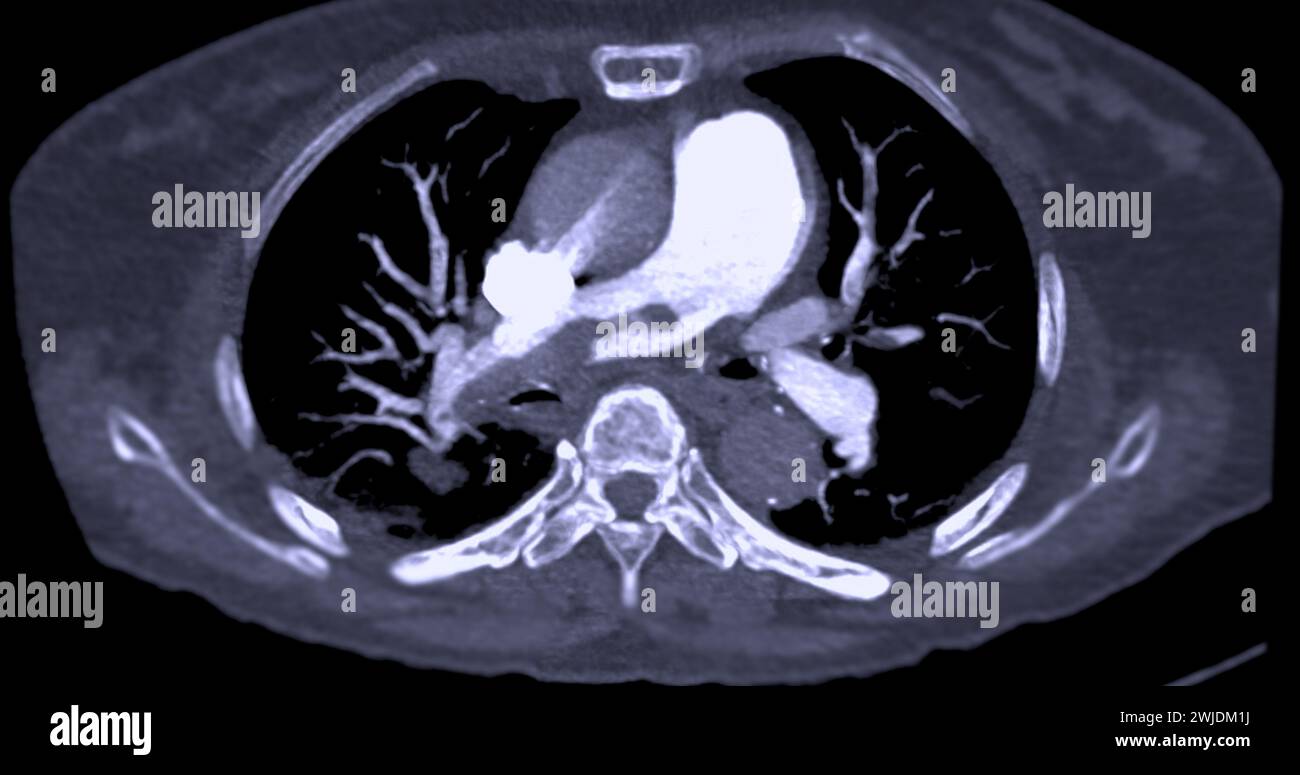 A CTA pulmonary artery reveals a detailed view of the lung blood ...