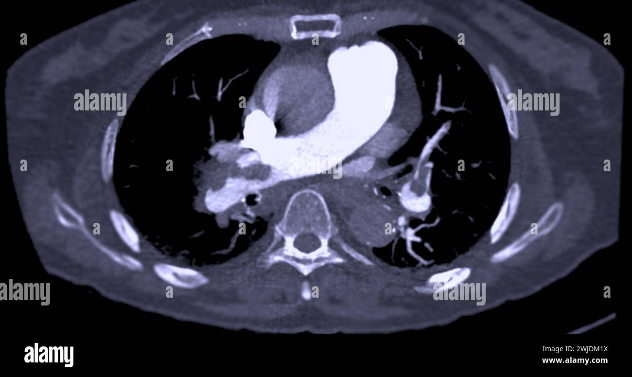 A CTA pulmonary artery reveals a detailed view of the lung blood ...