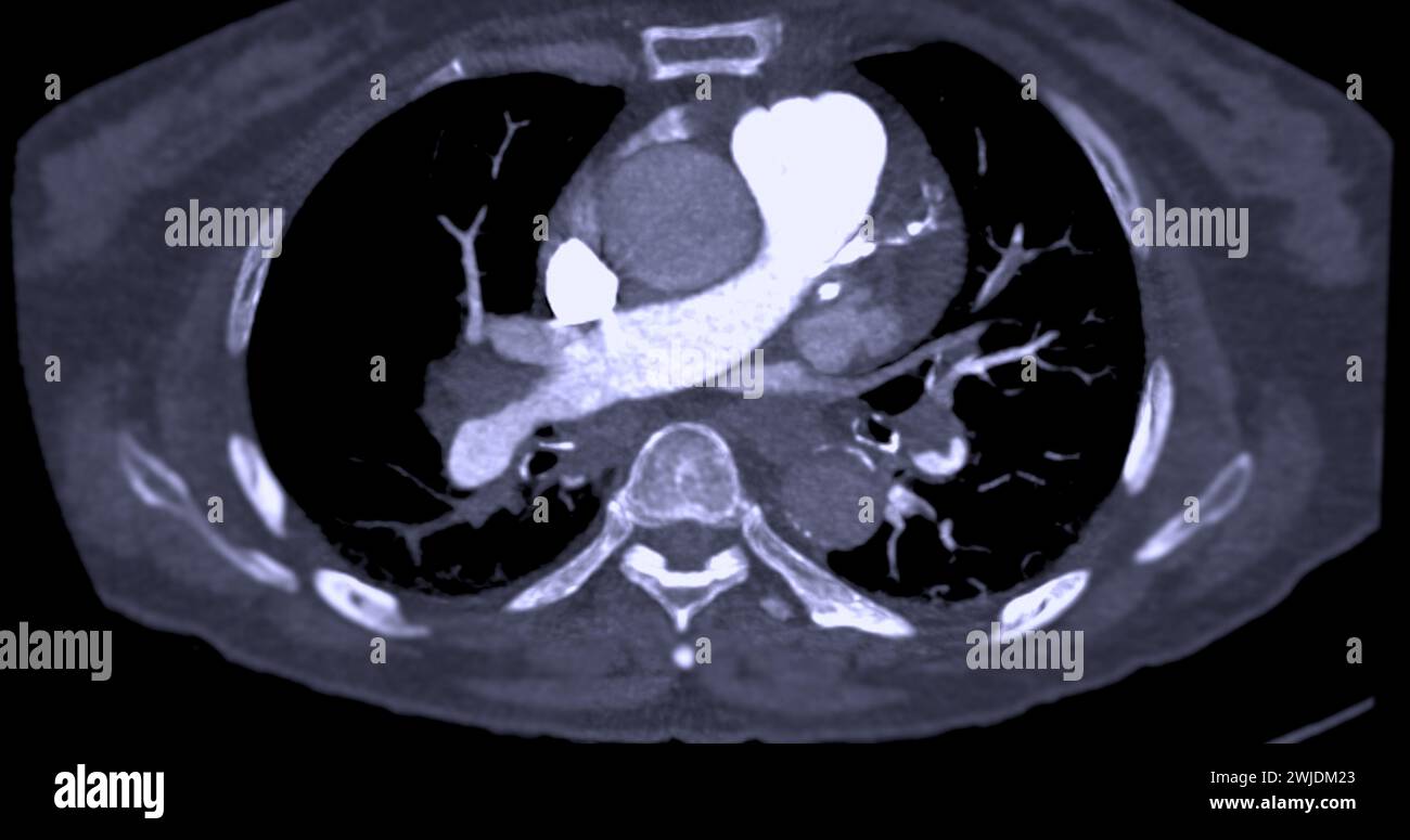 A CTA pulmonary artery reveals a detailed view of the lung blood ...