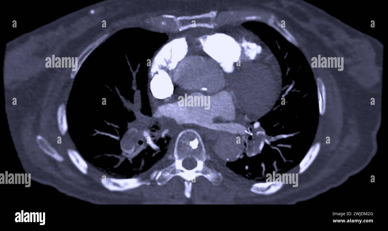 A CTA pulmonary artery reveals a detailed view of the lung blood ...