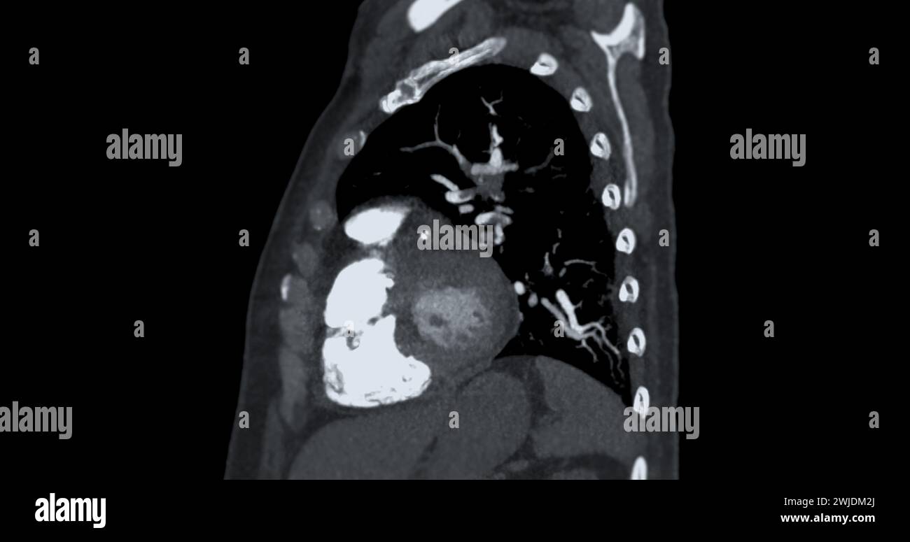 A CTA pulmonary artery reveals a detailed view of the lung blood ...