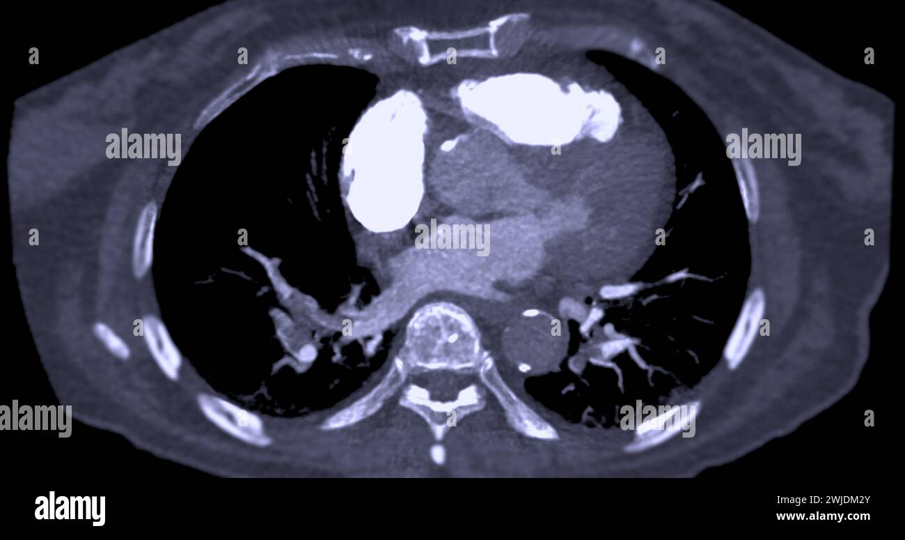 A CTA pulmonary artery reveals a detailed view of the lung blood ...