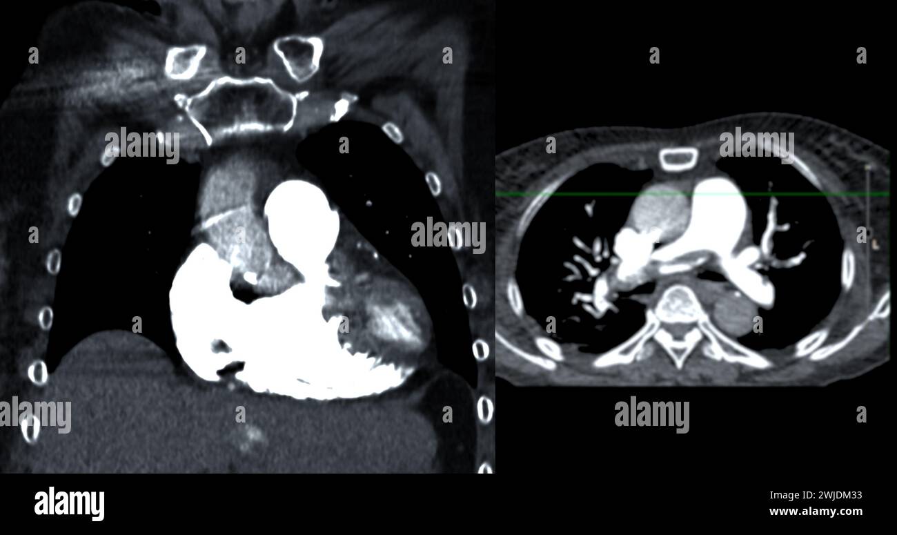 A CTA pulmonary artery reveals a detailed view of the lung blood ...