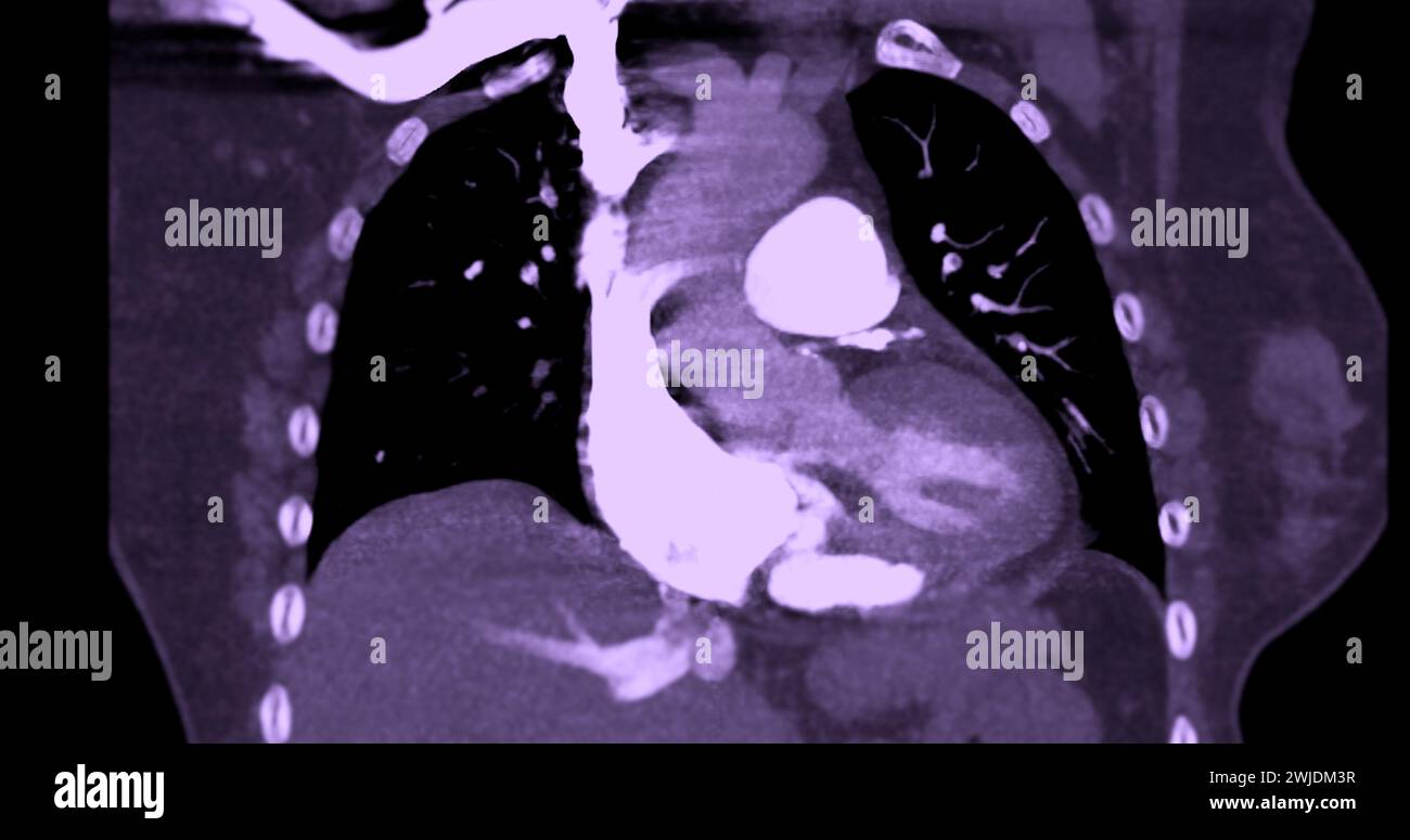 A CTA pulmonary artery reveals a detailed view of the lung blood ...