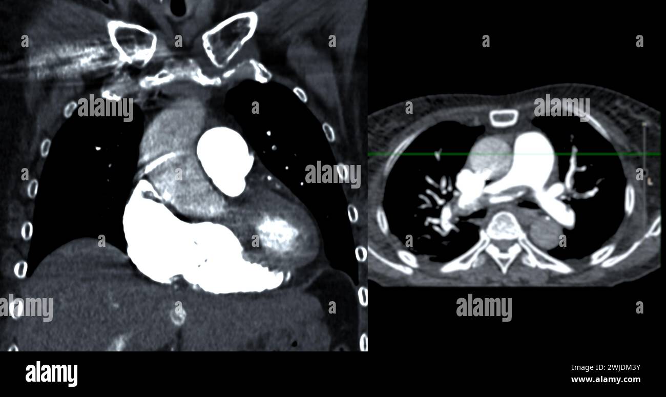 A CTA pulmonary artery reveals a detailed view of the lung blood ...
