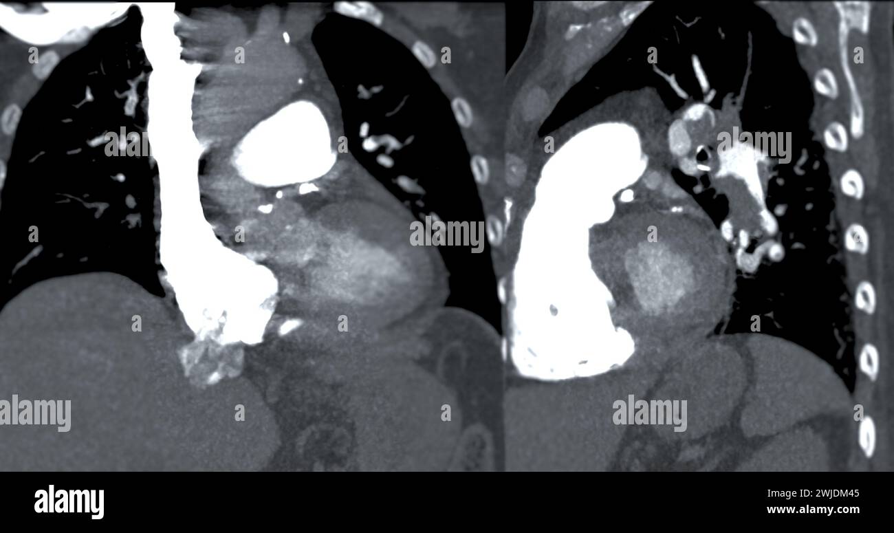 A CTA pulmonary artery reveals a detailed view of the lung blood ...