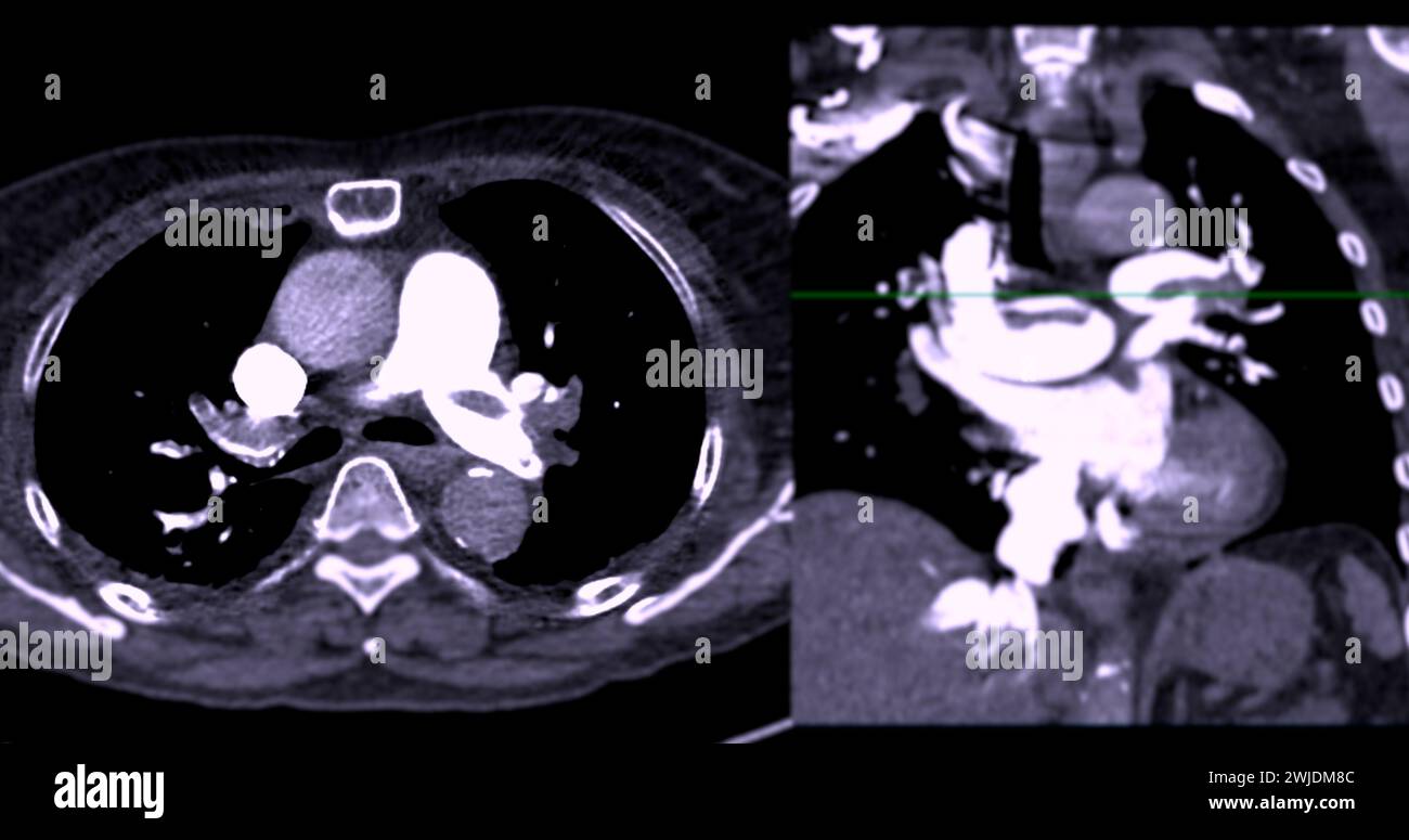 A CTA pulmonary artery reveals a detailed view of the lung blood ...