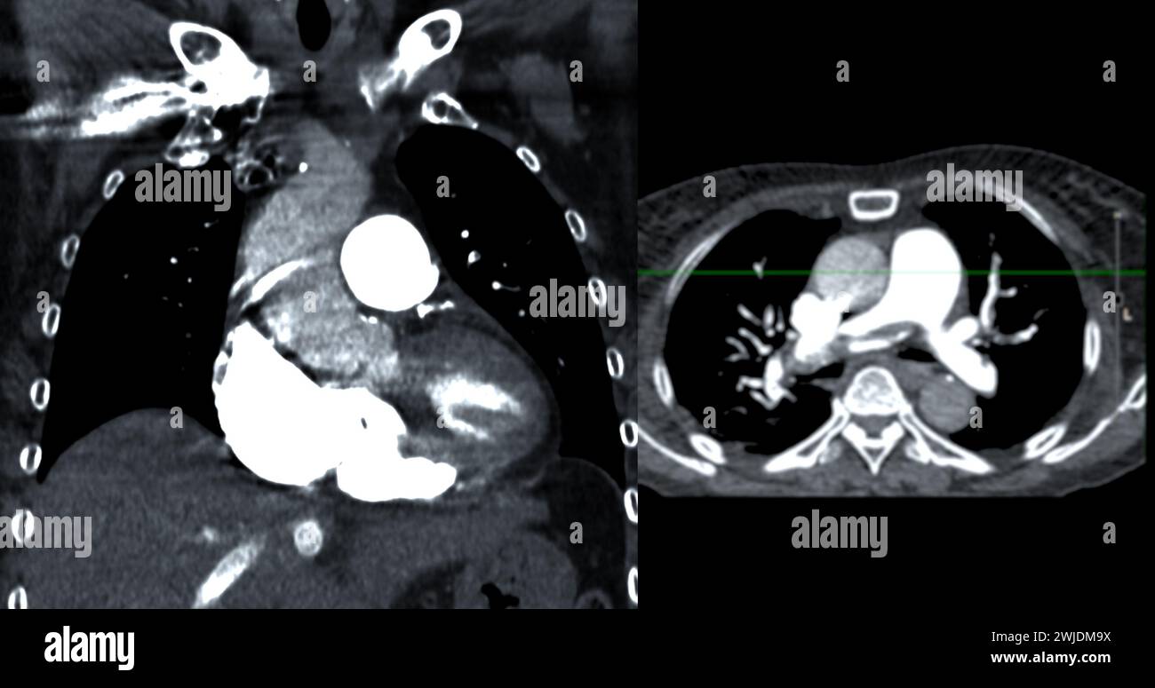 A CTA pulmonary artery reveals a detailed view of the lung blood ...