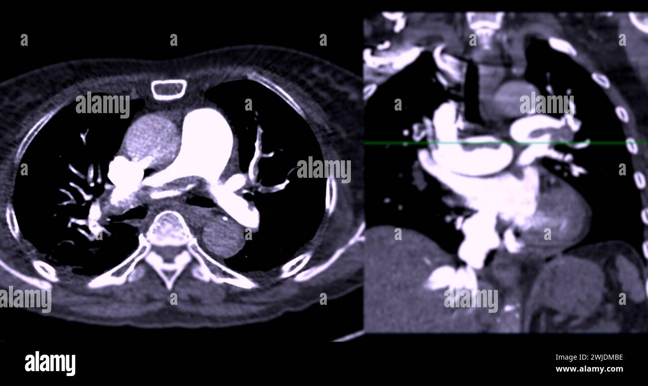A CTA pulmonary artery reveals a detailed view of the lung blood ...