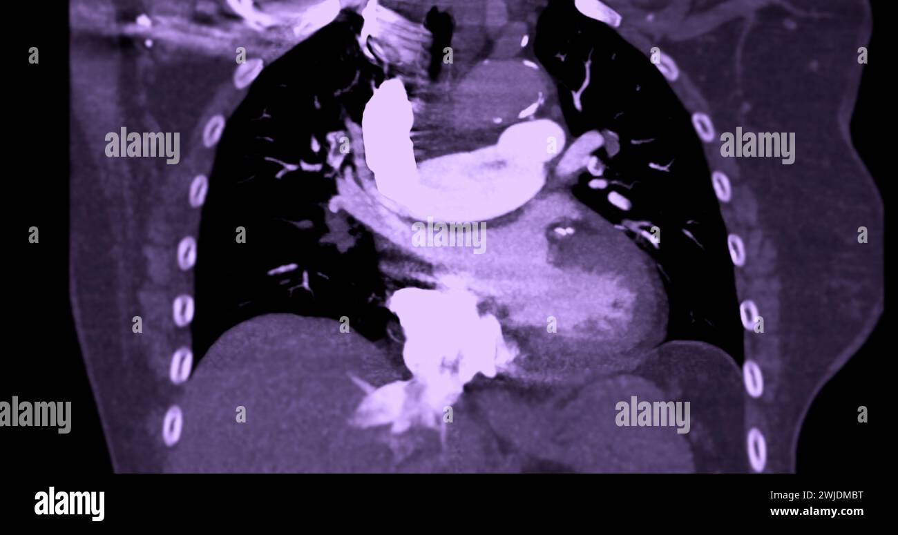 A CTA pulmonary artery reveals a detailed view of the lung blood ...