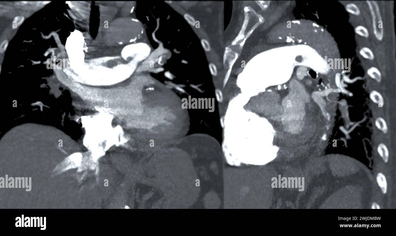 A CTA pulmonary artery reveals a detailed view of the lung blood ...