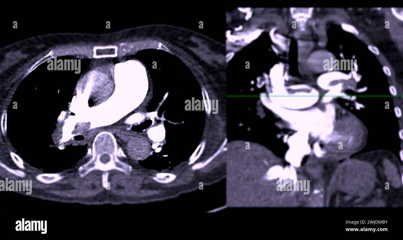 A CTA pulmonary artery reveals a detailed view of the lung blood ...