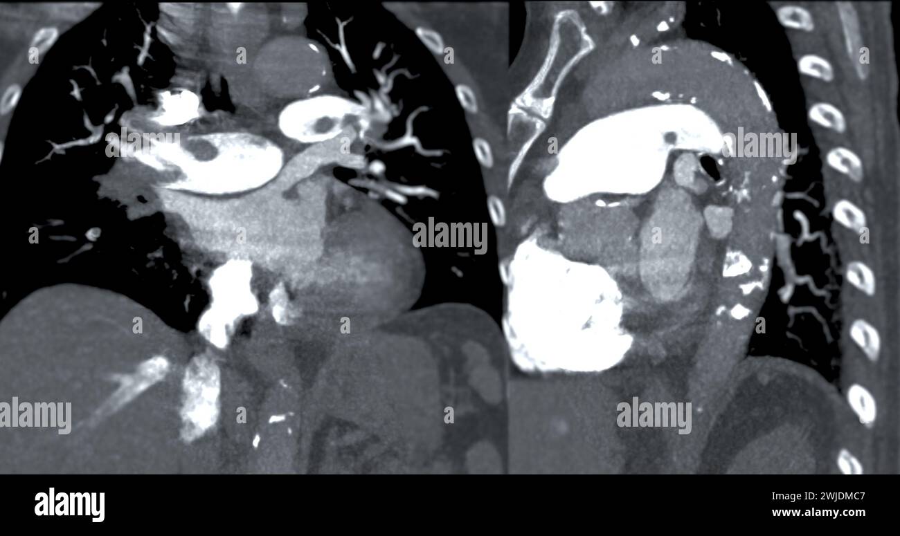 A CTA pulmonary artery reveals a detailed view of the lung blood ...