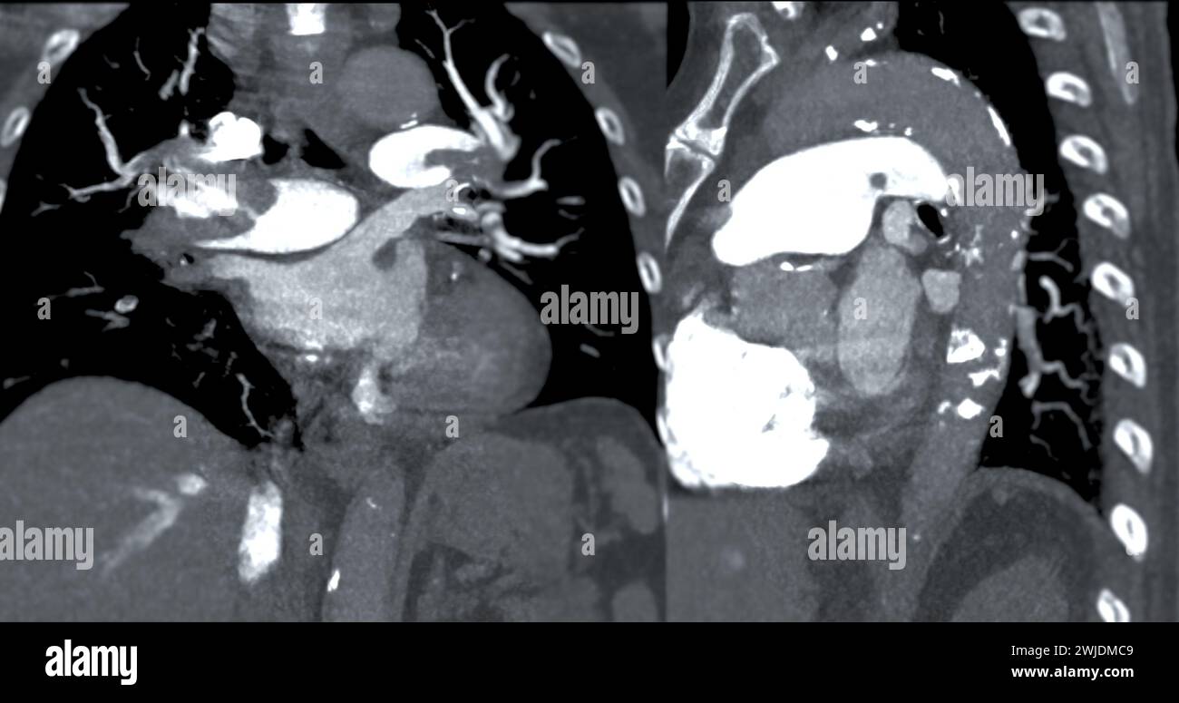 A CTA pulmonary artery reveals a detailed view of the lung blood ...