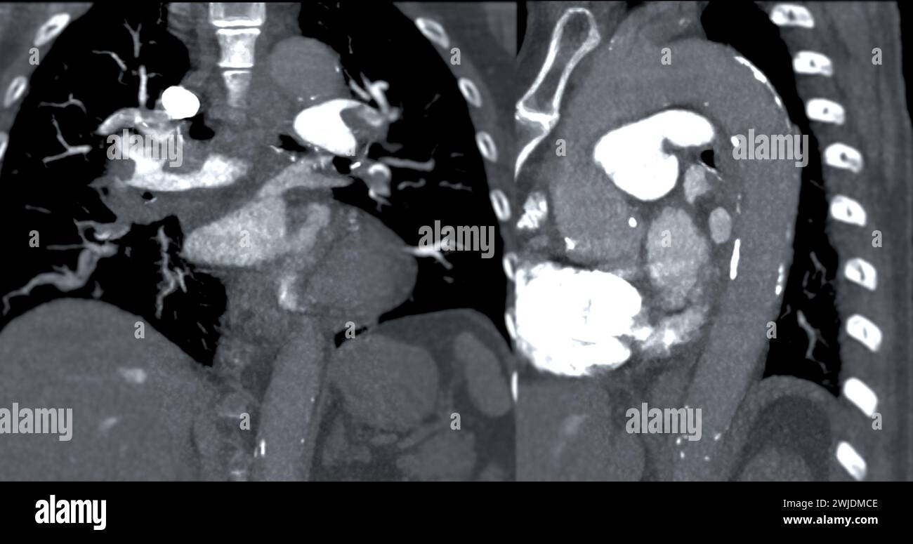 A CTA pulmonary artery reveals a detailed view of the lung blood ...
