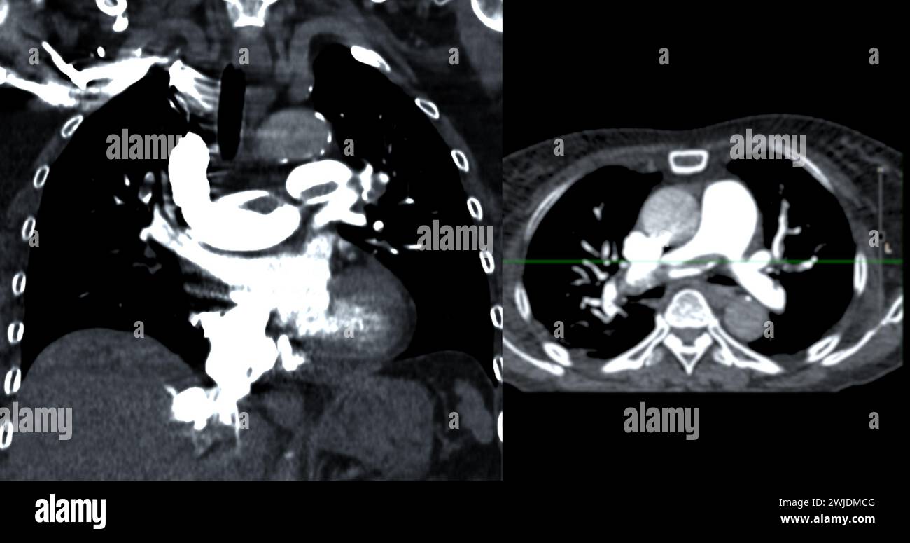 A CTA pulmonary artery reveals a detailed view of the lung blood ...