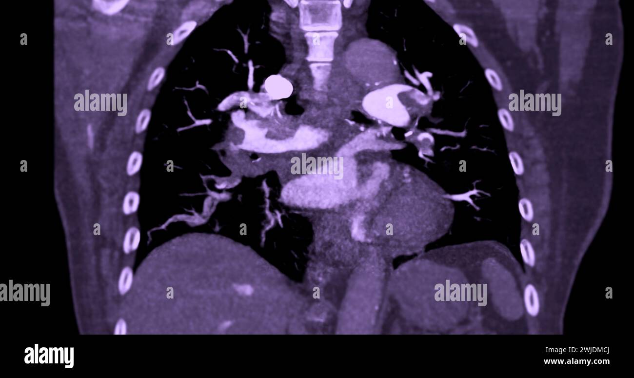 A CTA pulmonary artery reveals a detailed view of the lung blood ...