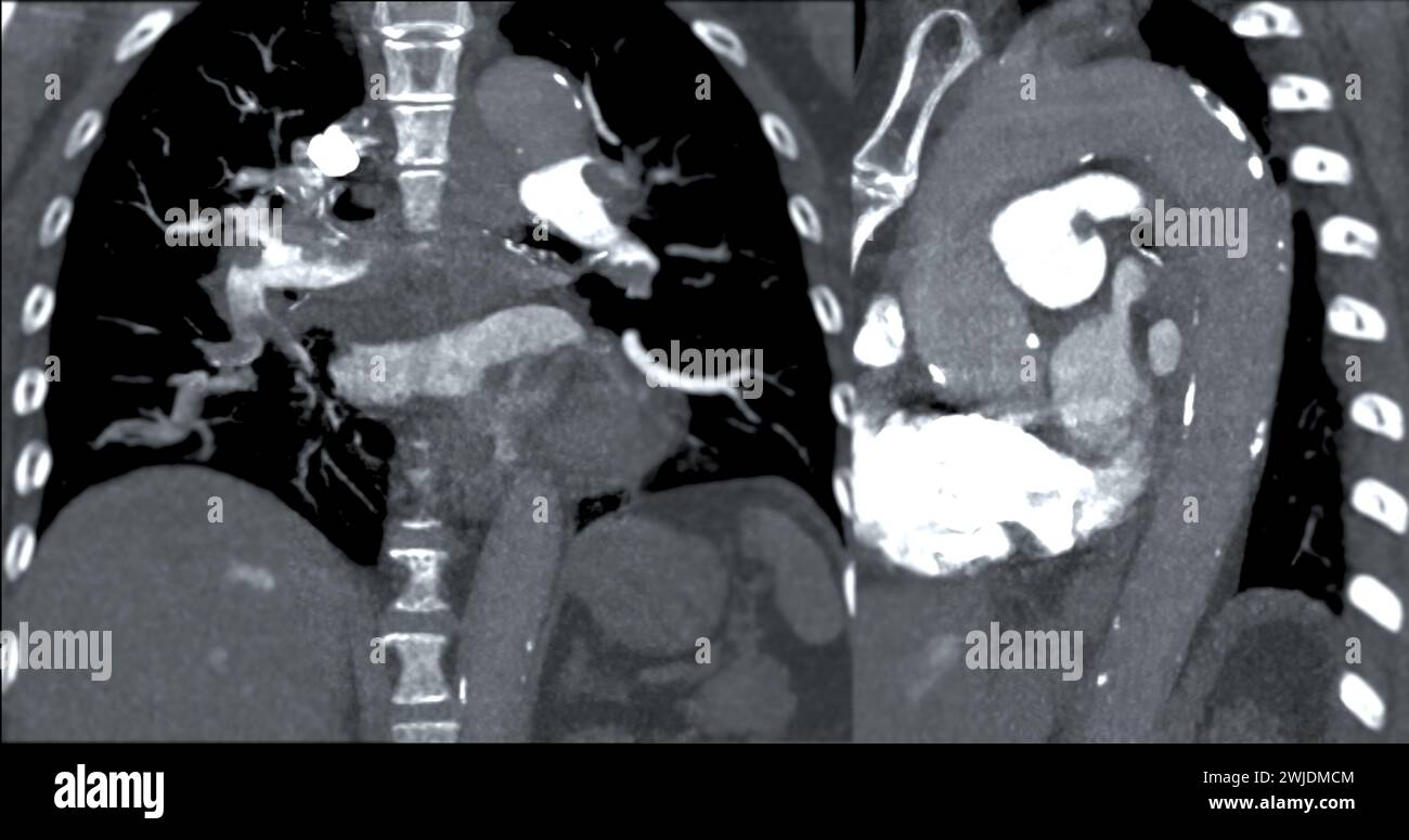 A CTA pulmonary artery reveals a detailed view of the lung blood ...