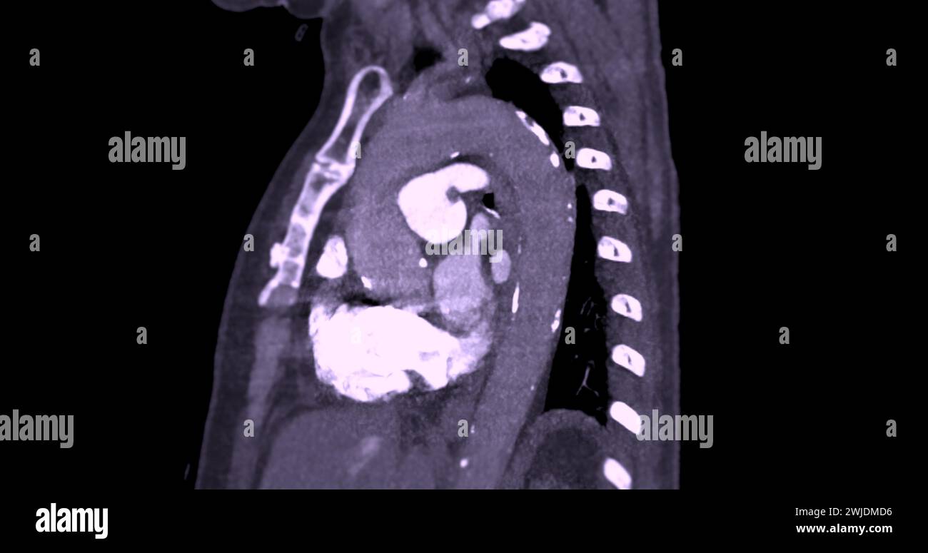 A CTA pulmonary artery reveals a detailed view of the lung blood ...