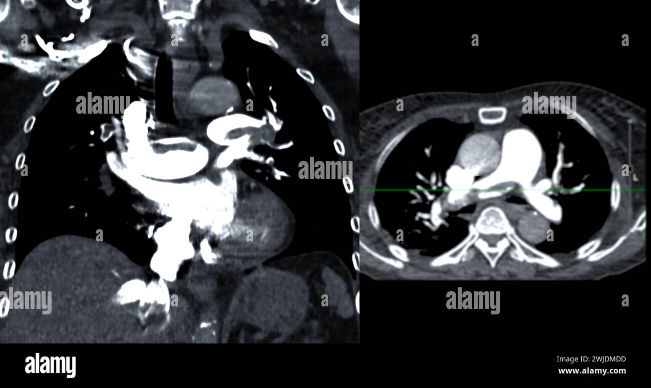 A CTA pulmonary artery reveals a detailed view of the lung blood ...