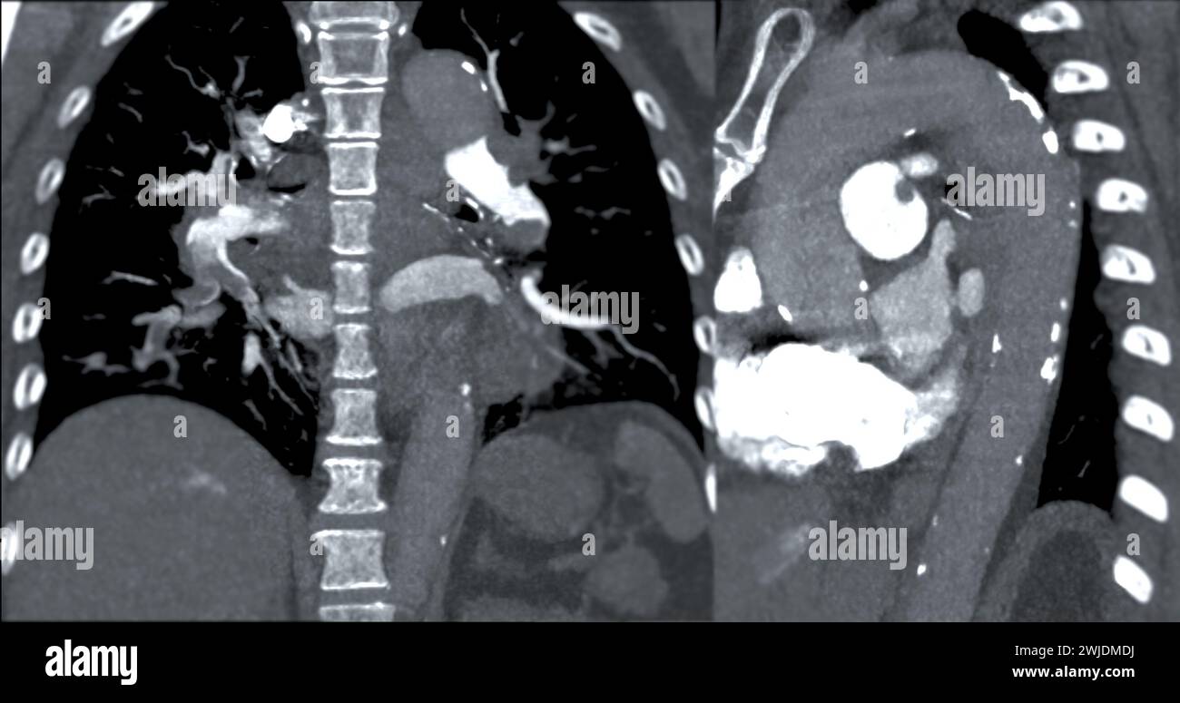A CTA pulmonary artery reveals a detailed view of the lung blood ...