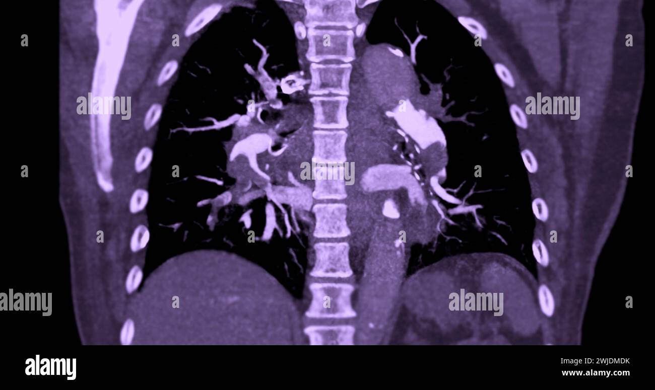 A CTA pulmonary artery reveals a detailed view of the lung blood ...