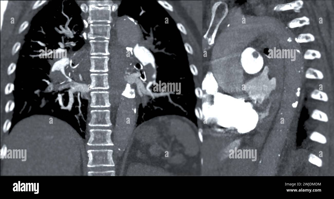 A CTA pulmonary artery reveals a detailed view of the lung blood ...