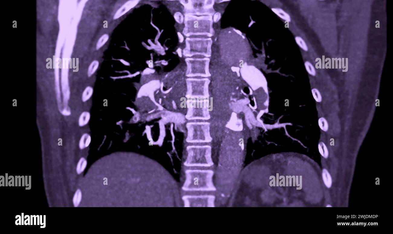 A CTA pulmonary artery reveals a detailed view of the lung blood ...