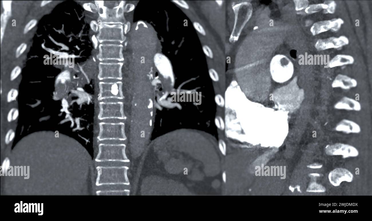 A CTA pulmonary artery reveals a detailed view of the lung blood ...