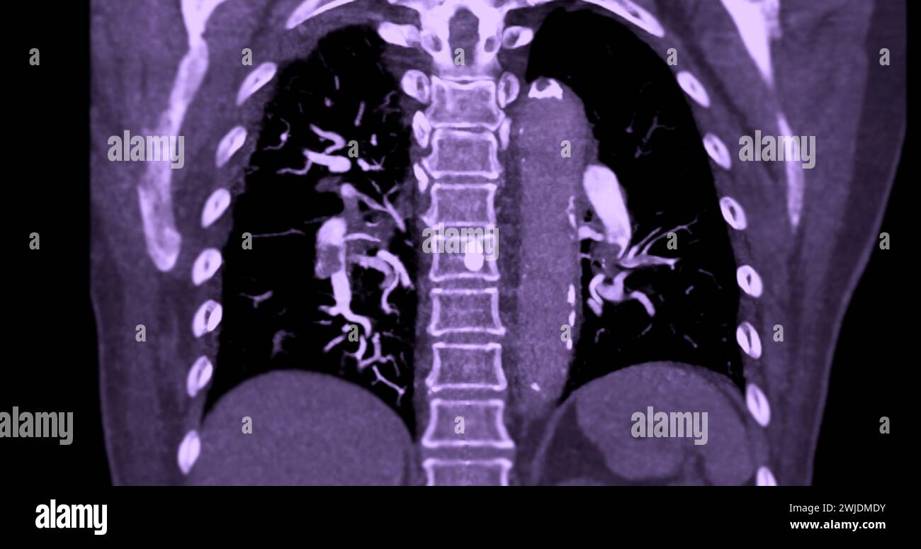 A CTA pulmonary artery reveals a detailed view of the lung blood ...