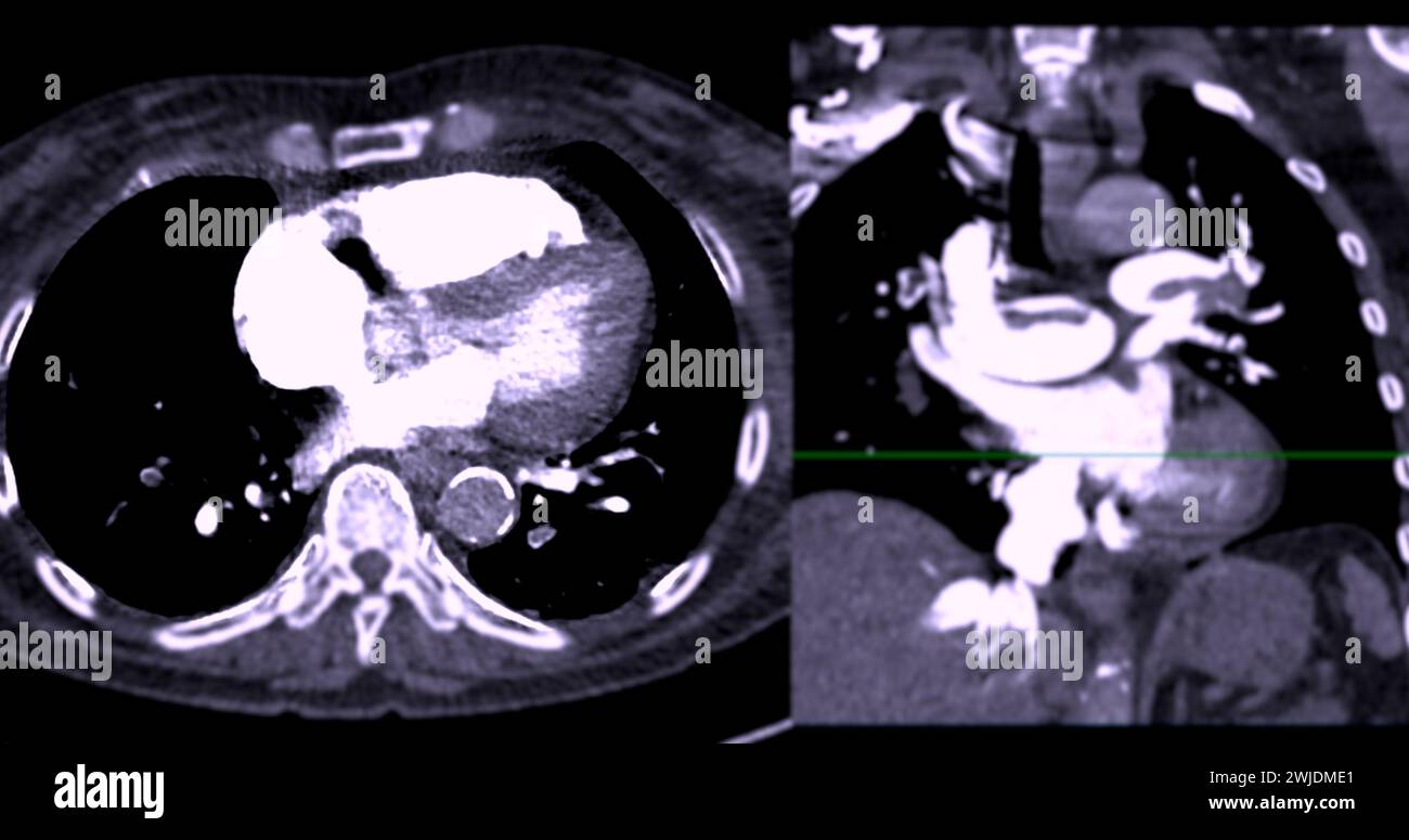 A CTA pulmonary artery reveals a detailed view of the lung blood ...