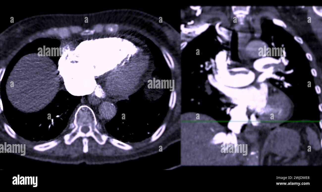 A CTA pulmonary artery reveals a detailed view of the lung blood ...